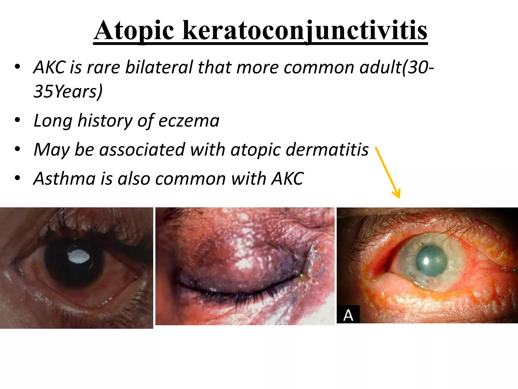 Allergic conjunctivitis | PPTX
