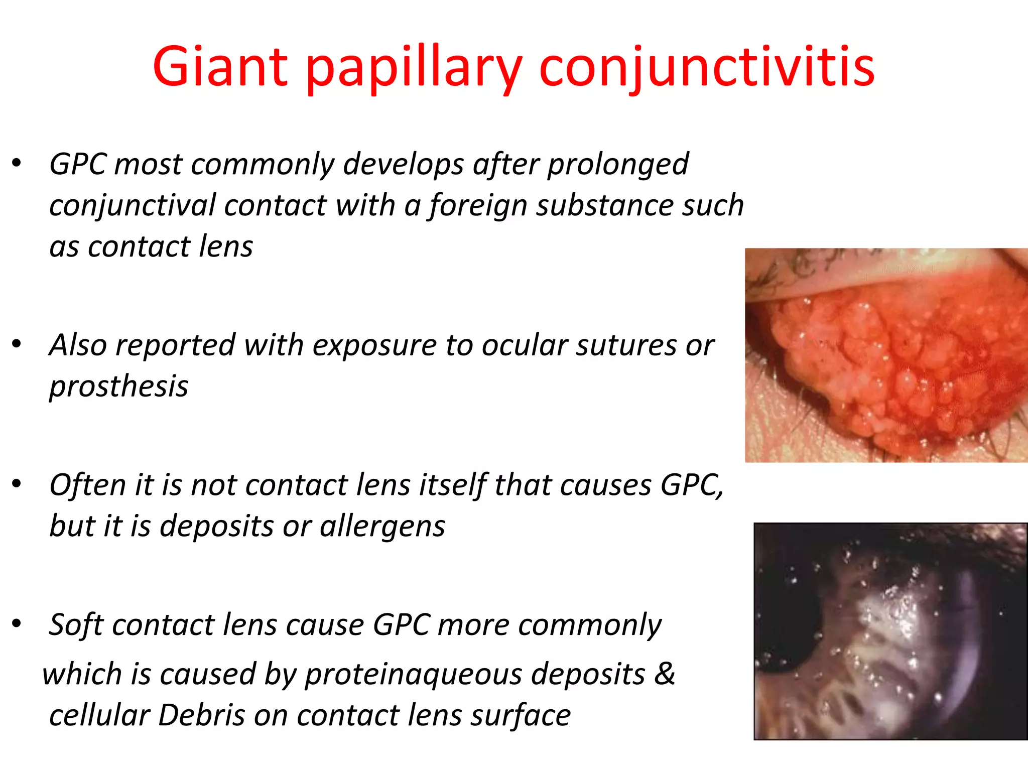 Allergic conjunctivitis | PPTX