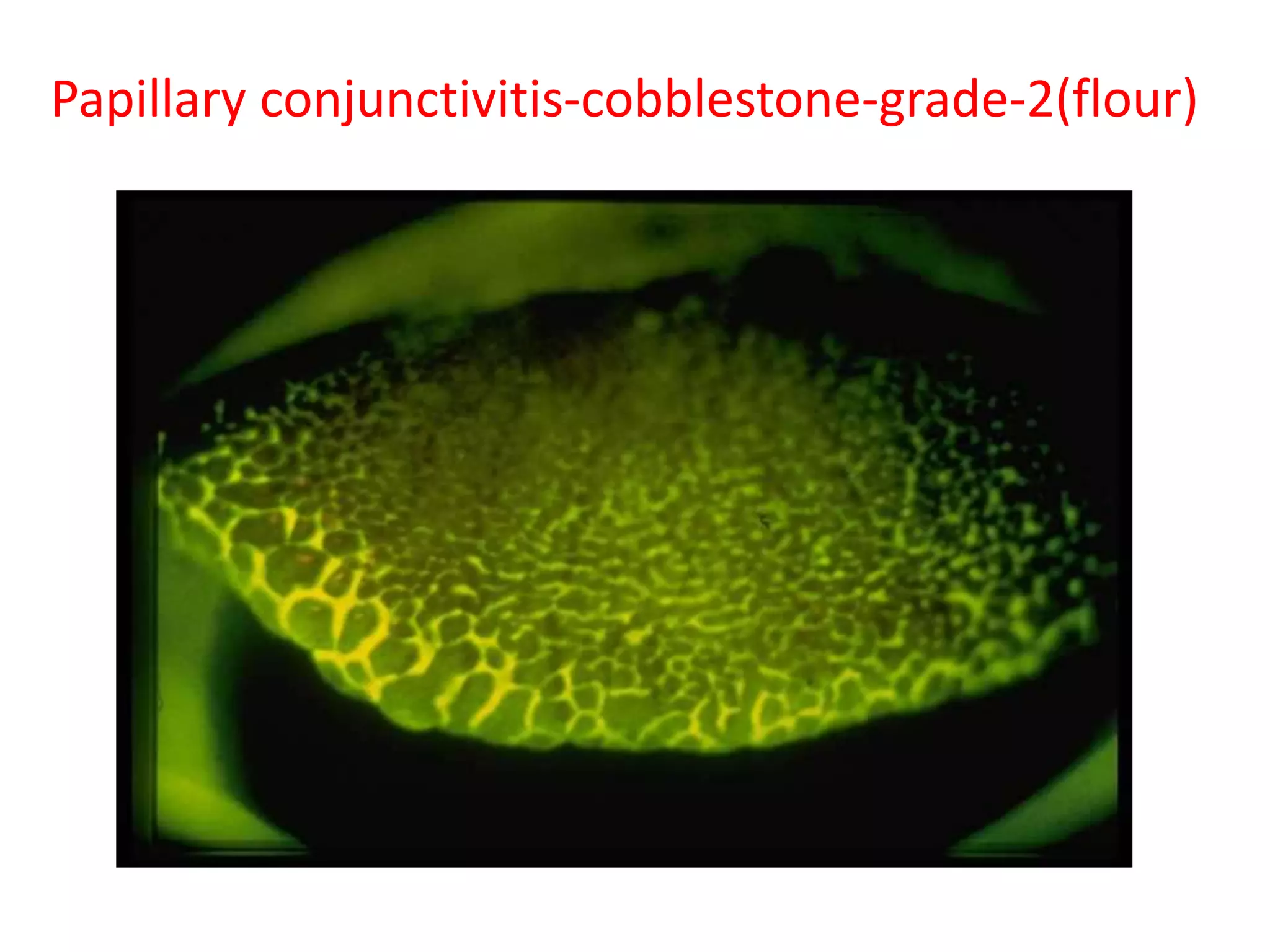 Allergic conjunctivitis | PPTX