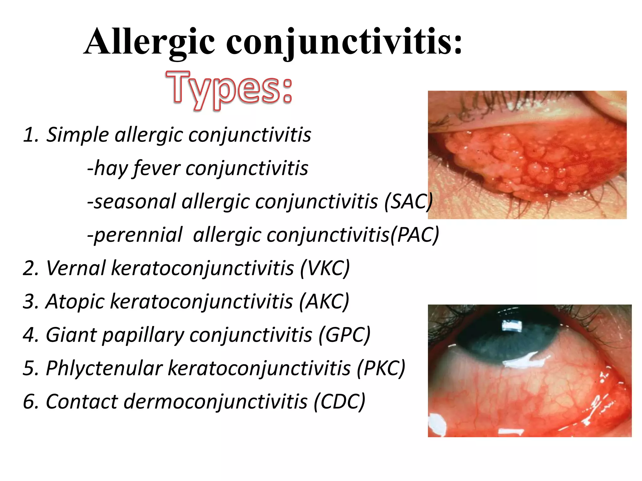 Allergic conjunctivitis | PPTX