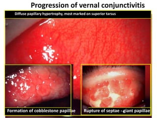 Allergic conjunctivitis | PPTX