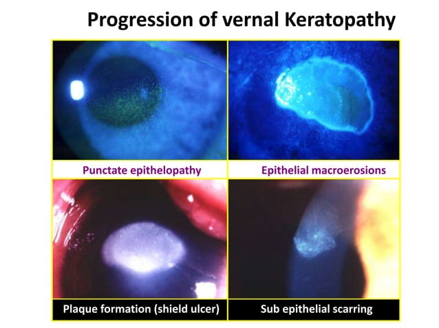 Allergic conjunctivitis | PPT