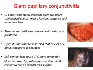 Allergic conjunctivitis