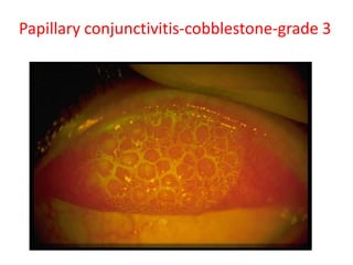 Papillary Conjunctivitis