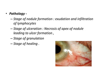 Giant Papillary Conjunctivitis Stages