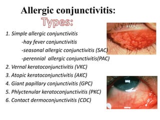 Giant Papillary Conjunctivitis