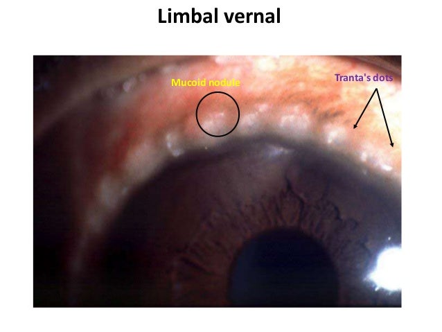 Allergic conjunctivitis