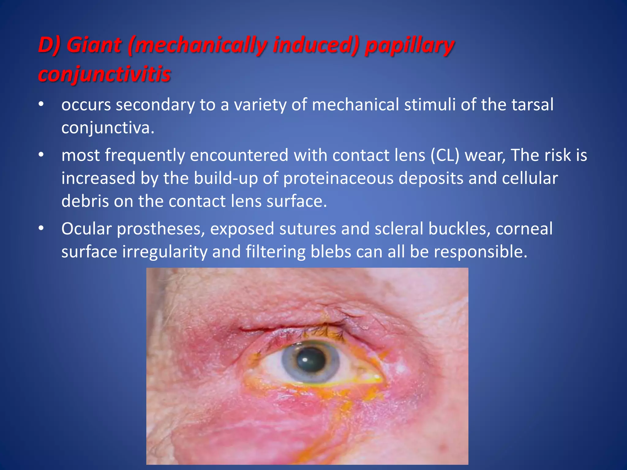 Allergic conjunctivitis | PPTX