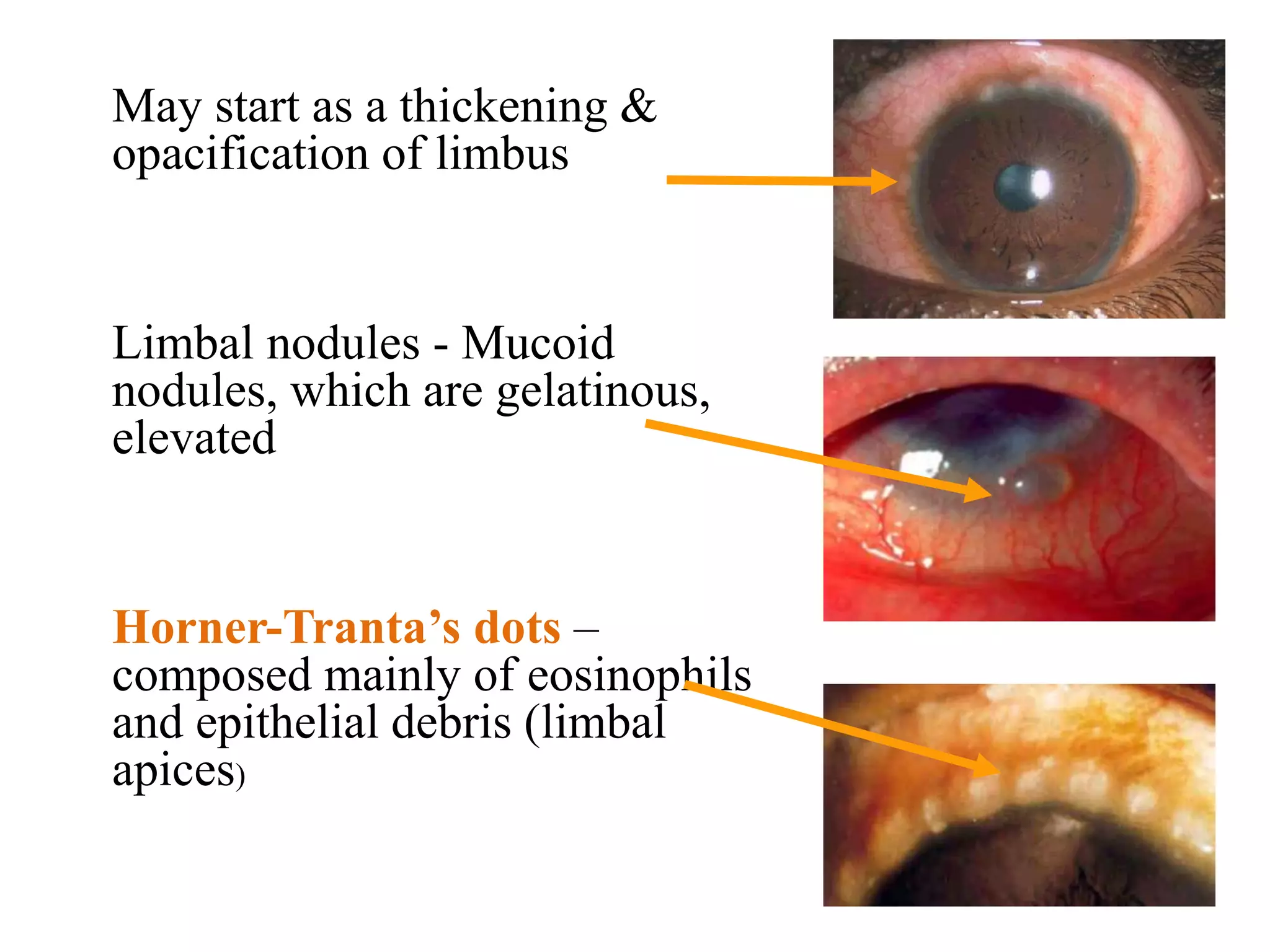 Allergic conjunctivitis | PPTX