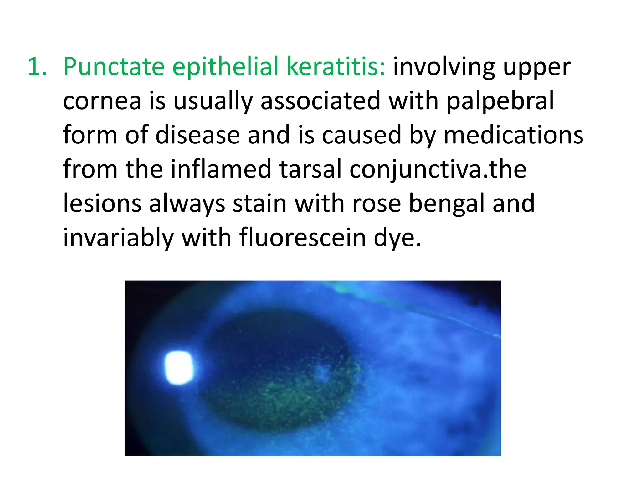 Allergic conjunctivitis | PPT