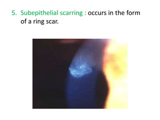 Allergic conjunctivitis | PPTX