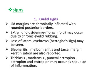 Allergic conjunctivitis | PPTX