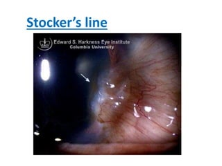 Allergic conjunctivitis | PPTX