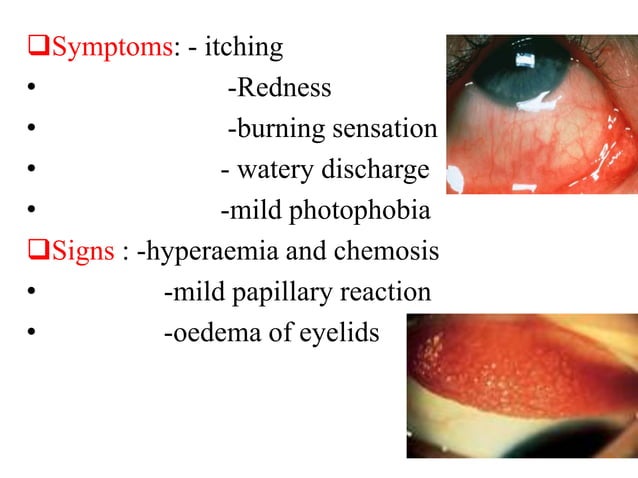 Allergic conjunctivitis | PPT
