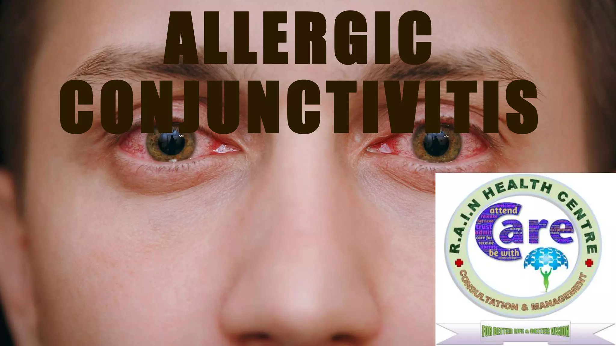 Allergic conjunctivitis | PPTX