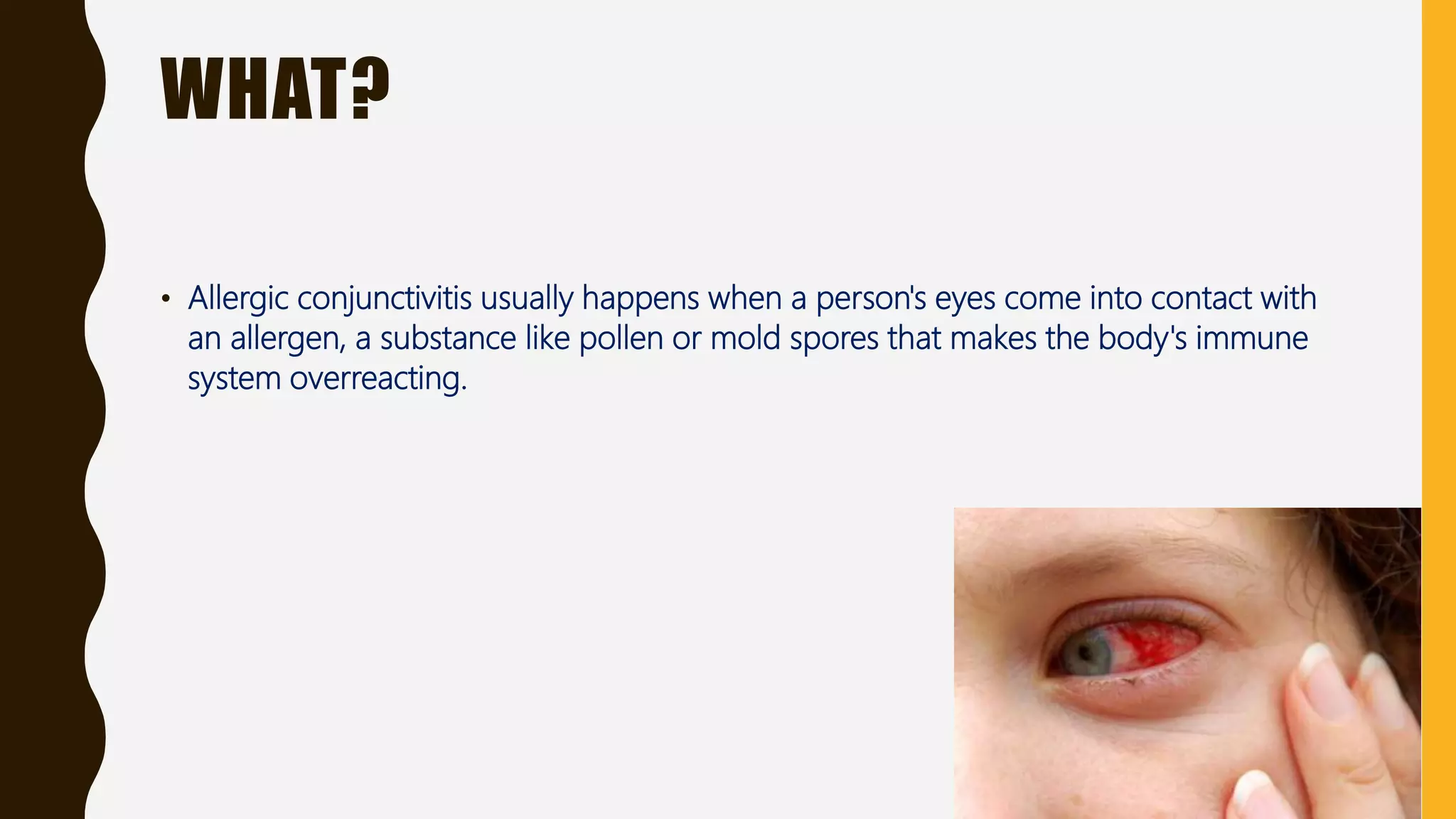 Allergic conjunctivitis | PPTX