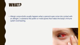 Allergic conjunctivitis | PPT