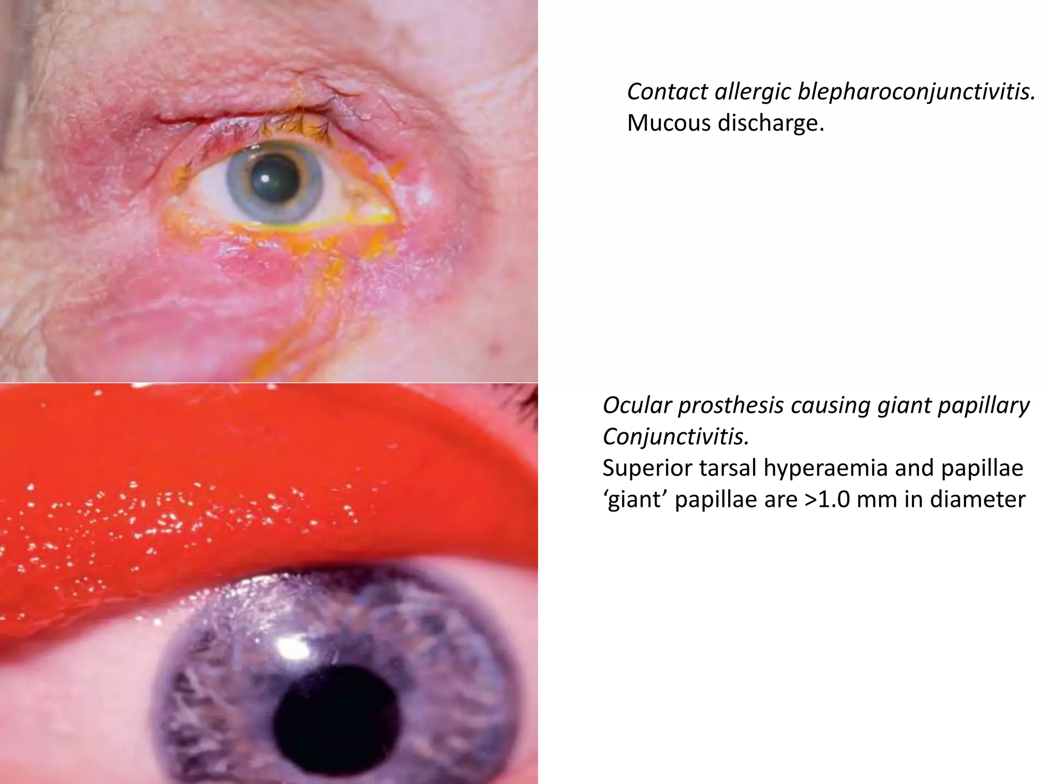 Allergic conjunctivitis | PPTX