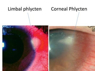 Allergic conjunctivitis | PPTX