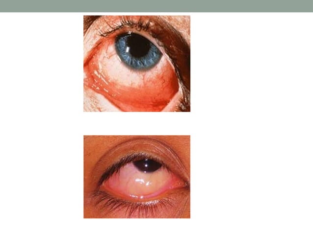 Allergic Conjunctivitis Pptx Ocular Surface Ppt