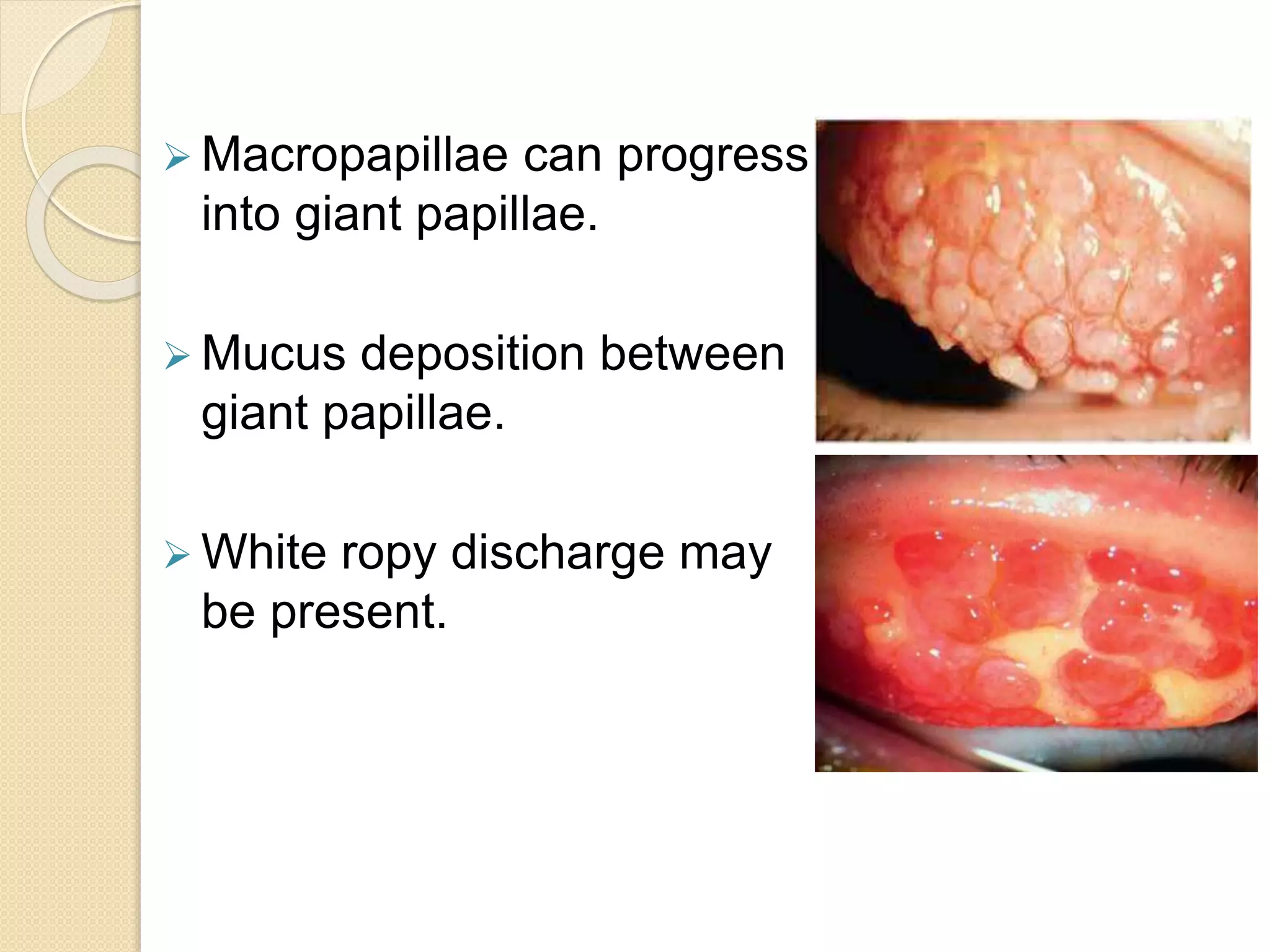 Allergic Conjuntivitis | PPTX