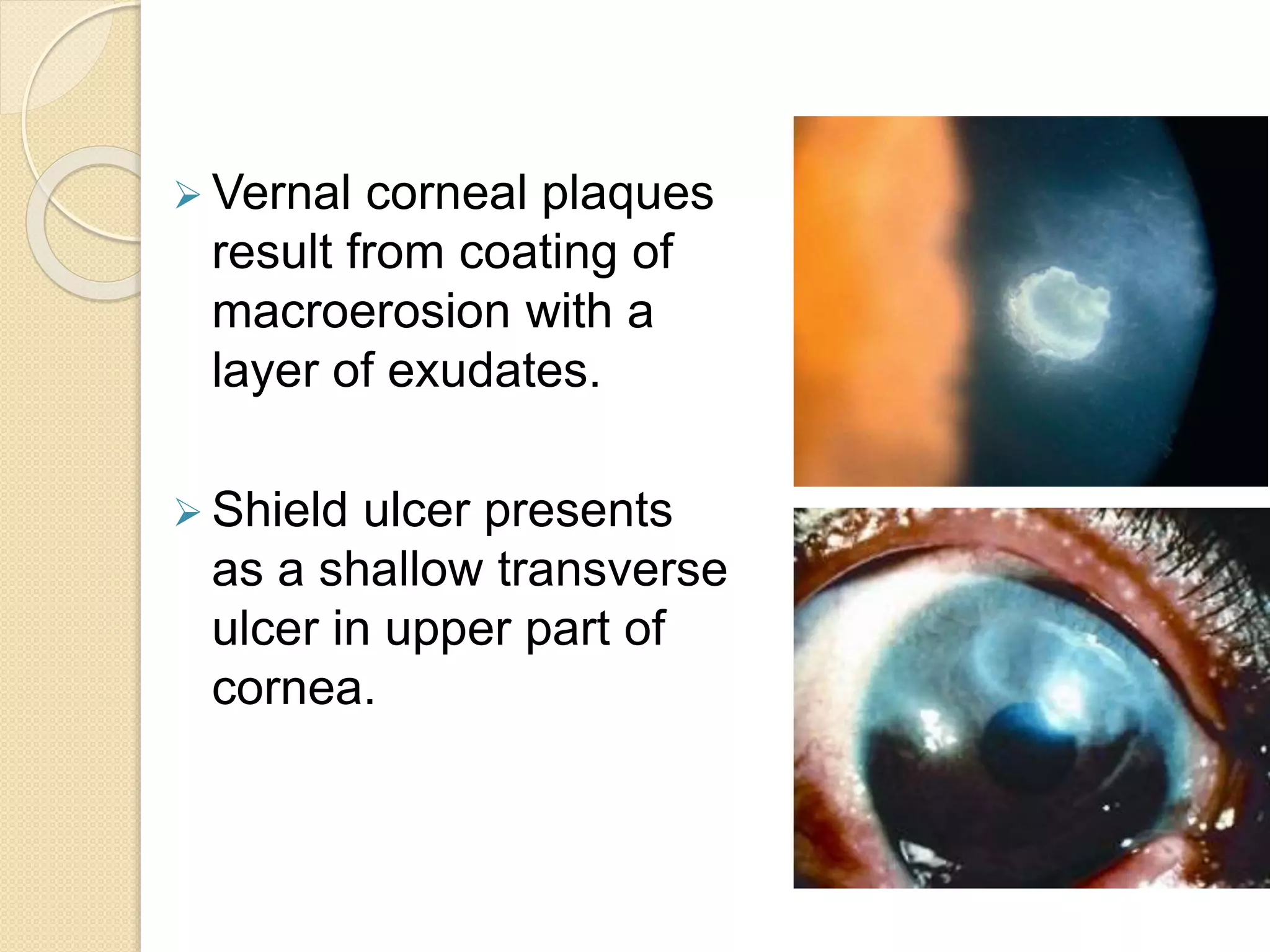 Allergic Conjuntivitis | PPTX