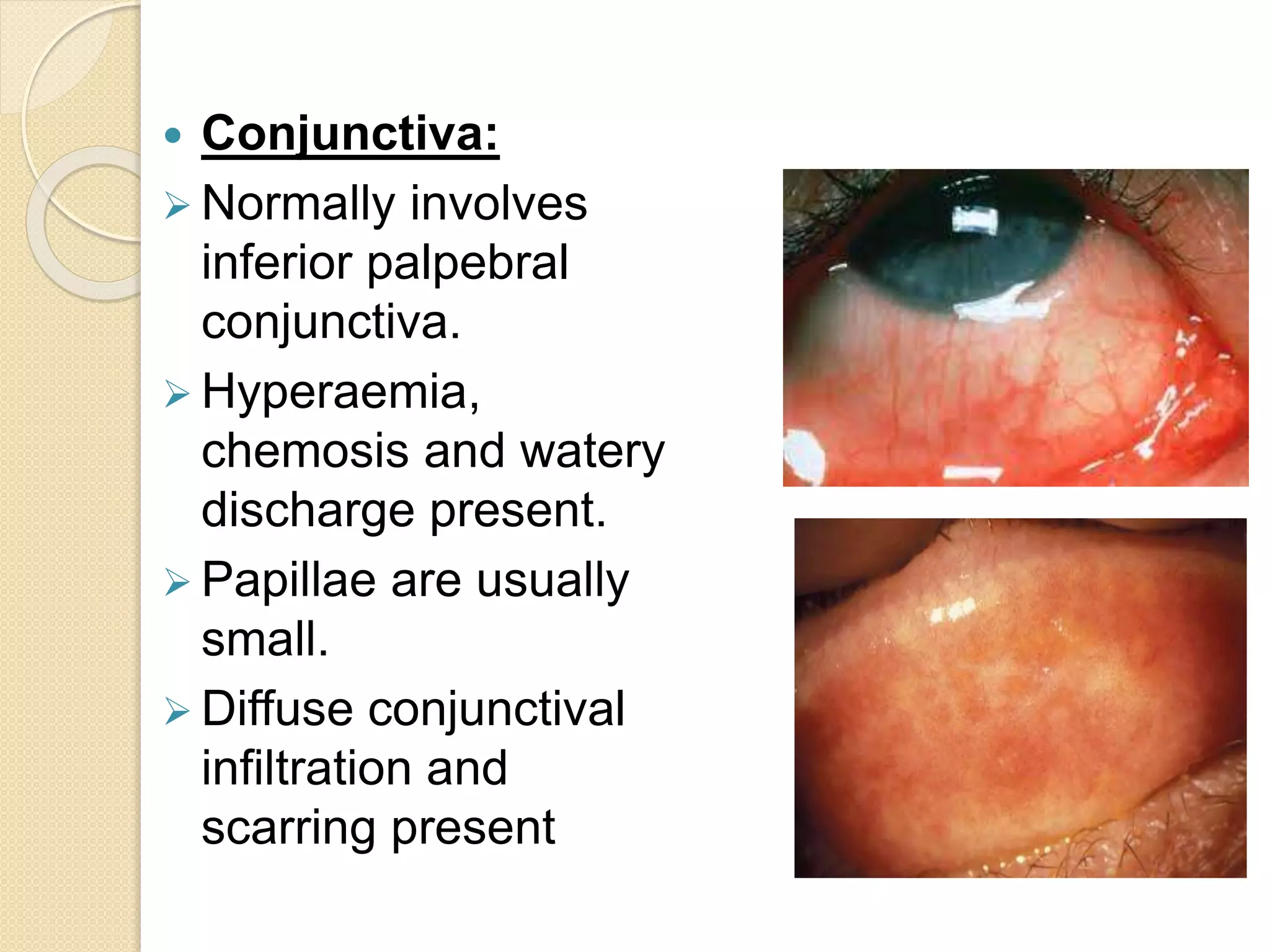 Allergic Conjuntivitis | PPTX