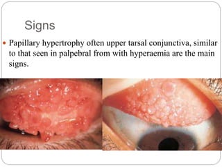 Allergic counjuctivitis | PPTX | Allergies | Diseases and Conditions