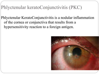 Allergic counjuctivitis | PPTX | Allergies | Diseases and Conditions