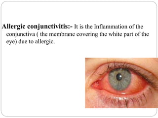 Allergic counjuctivitis | PPTX | Allergies | Diseases and Conditions