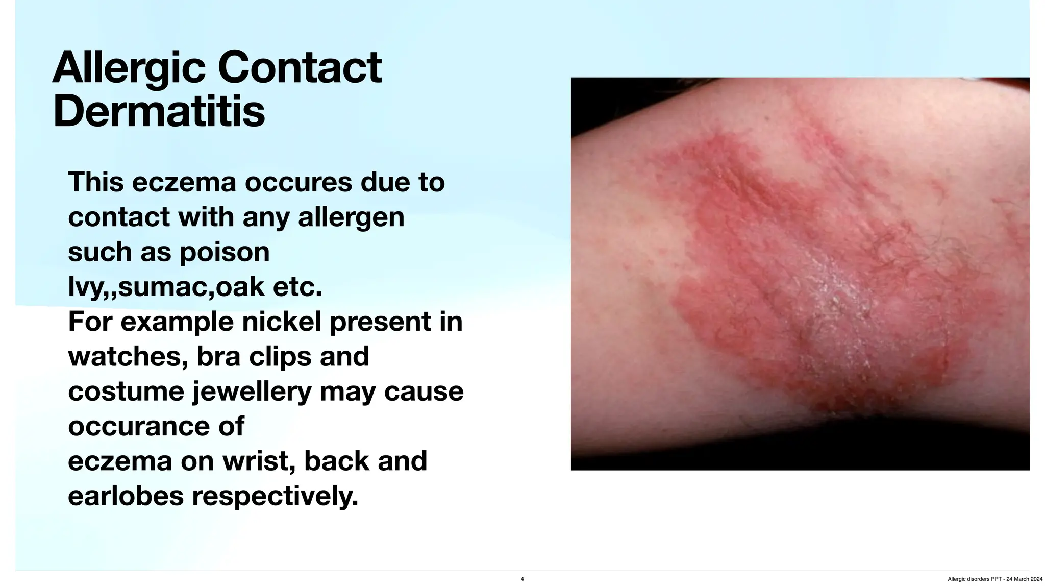 Allergic disorders PPT.................. | PDF