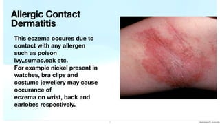 Allergic disorders PPT.................. | PDF
