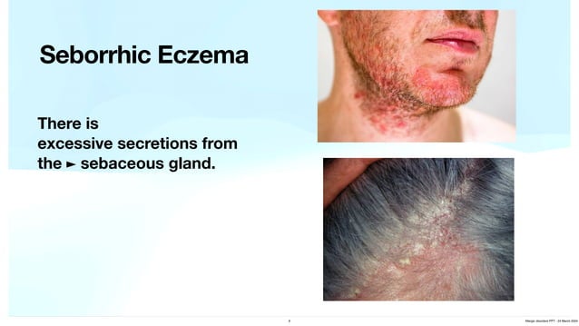 Allergic disorders PPT.................. | PDF | Skin and Dermatology ...