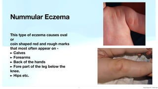 Allergic disorders PPT.................. | PDF