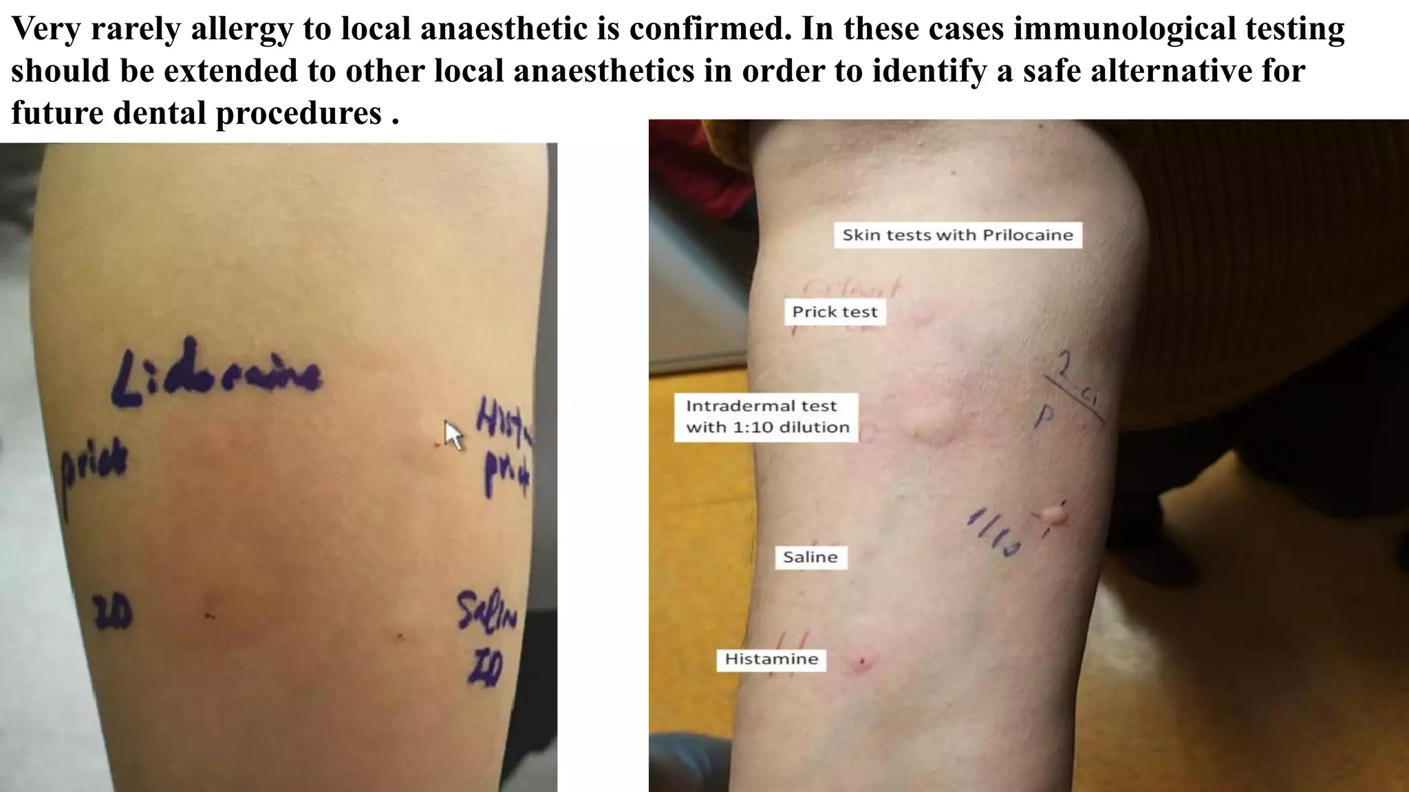 ALLERGIC REACTION OF LA.pdf