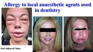 ALLERGIC REACTION OF LA.pdf