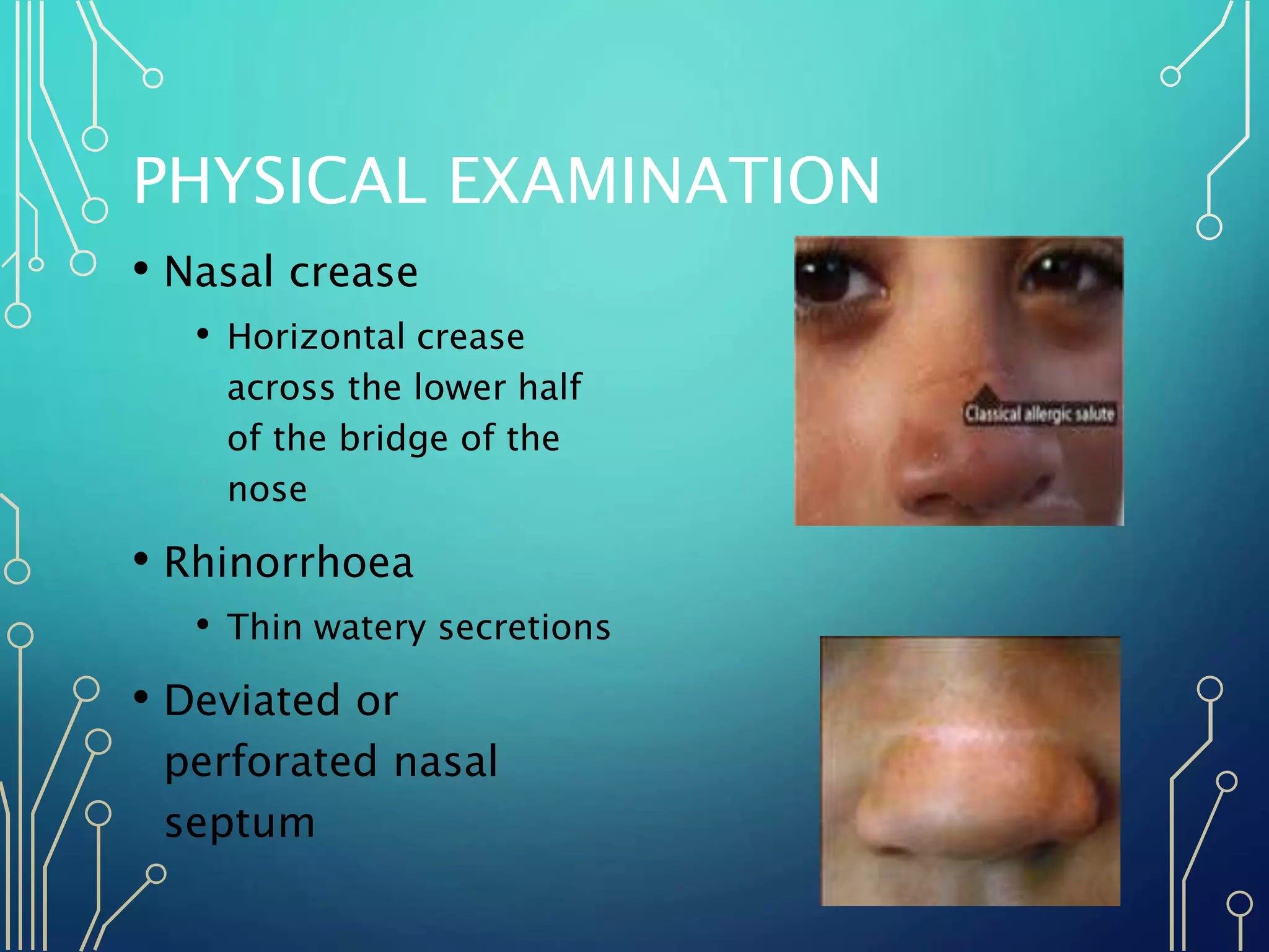Allergic rhinitis - presentation | PPTX