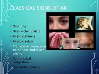 Allergic rhinitis - presentation | PPTX