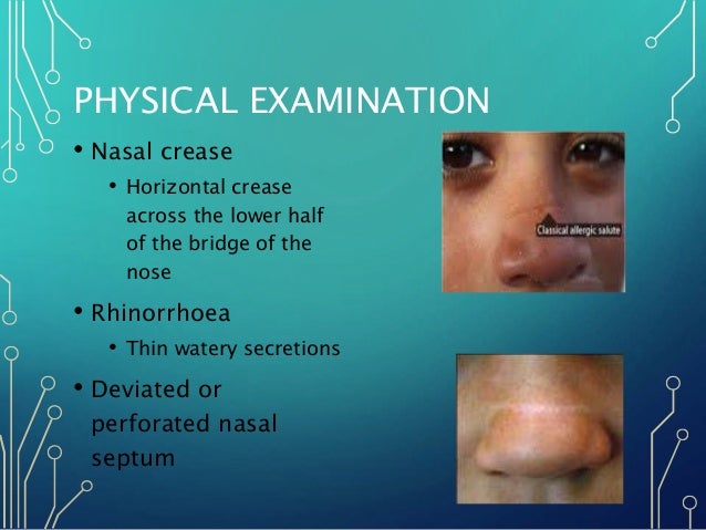 Allergic rhinitis - presentation