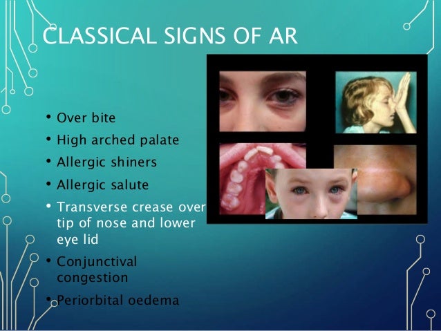 Allergic rhinitis - presentation