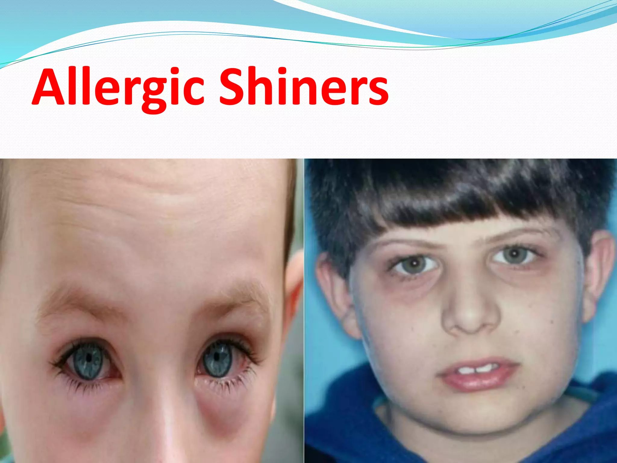Allergic rhinitis(summarized,informative) | PPTX