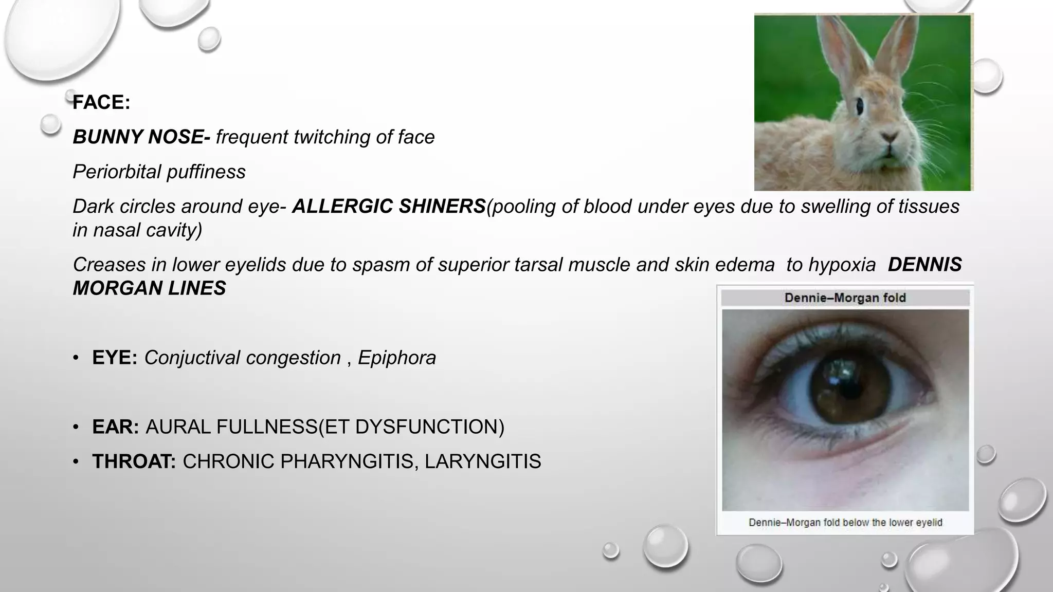 Allergic rhinitis | PPTX