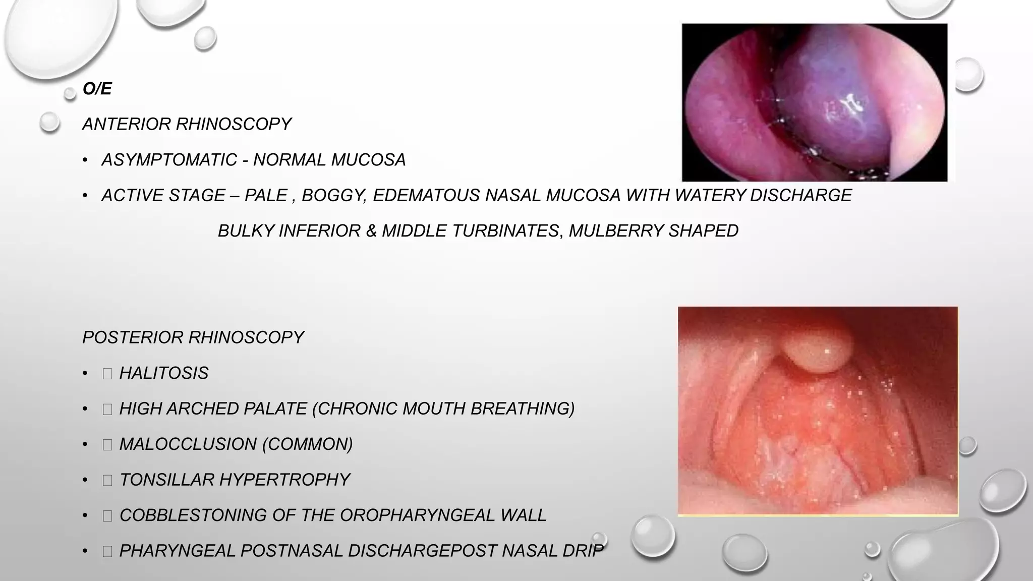Allergic rhinitis | PPTX