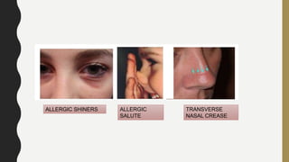 Allergic rhinitis | PPTX