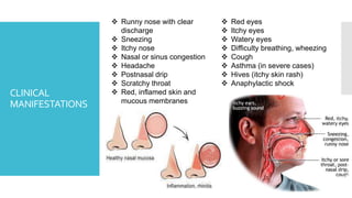 Allergic rhinitis | PPTX