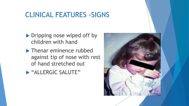 Allergic Rhinitis.ppt