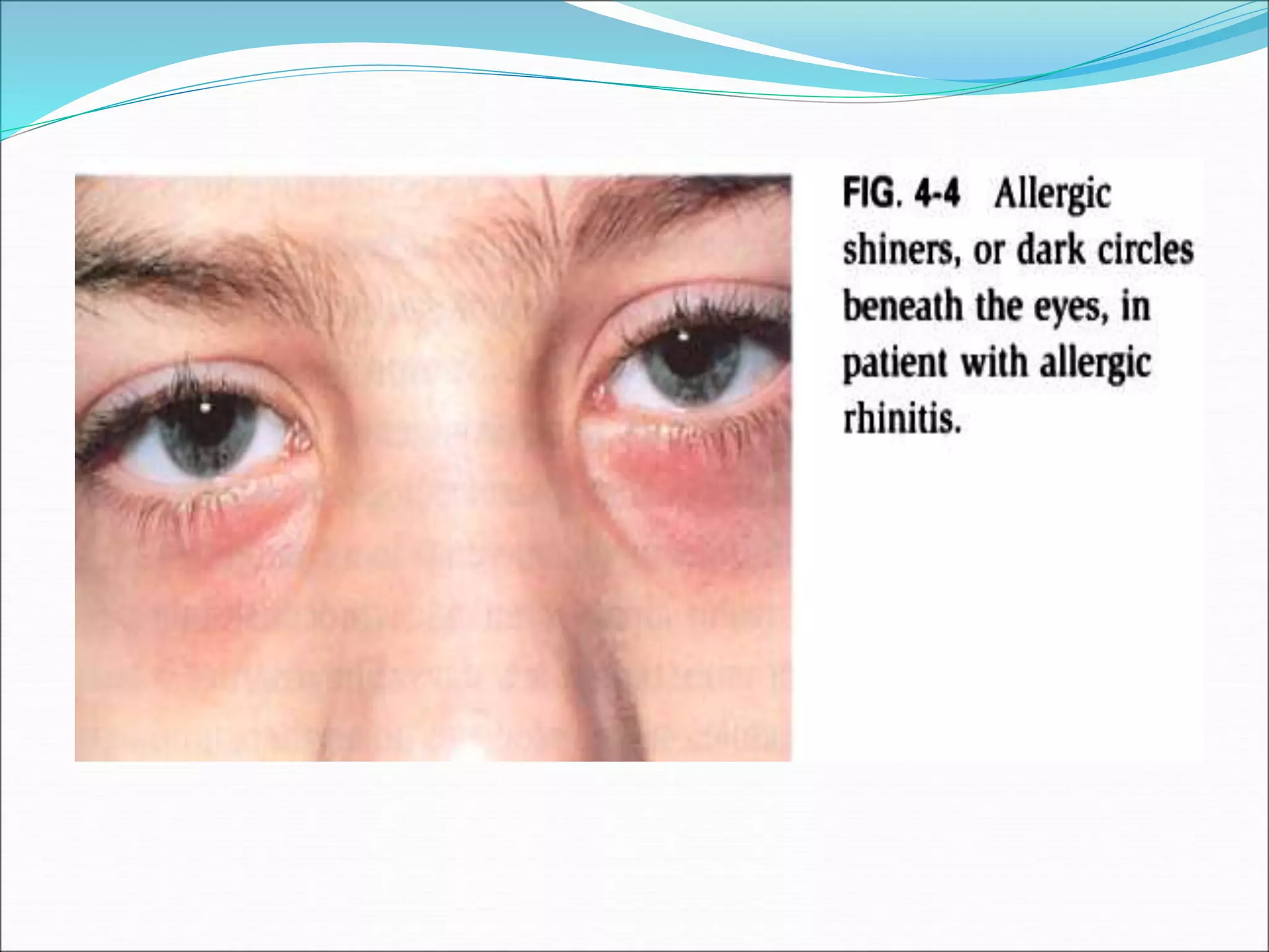 ALLERGIC RHINITIS.ppt | Allergies | Diseases and Conditions