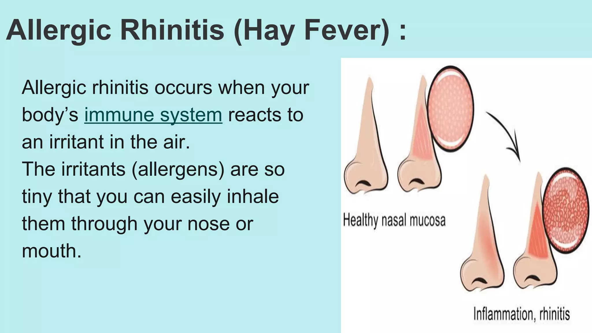 allergic rhinitis.pdf