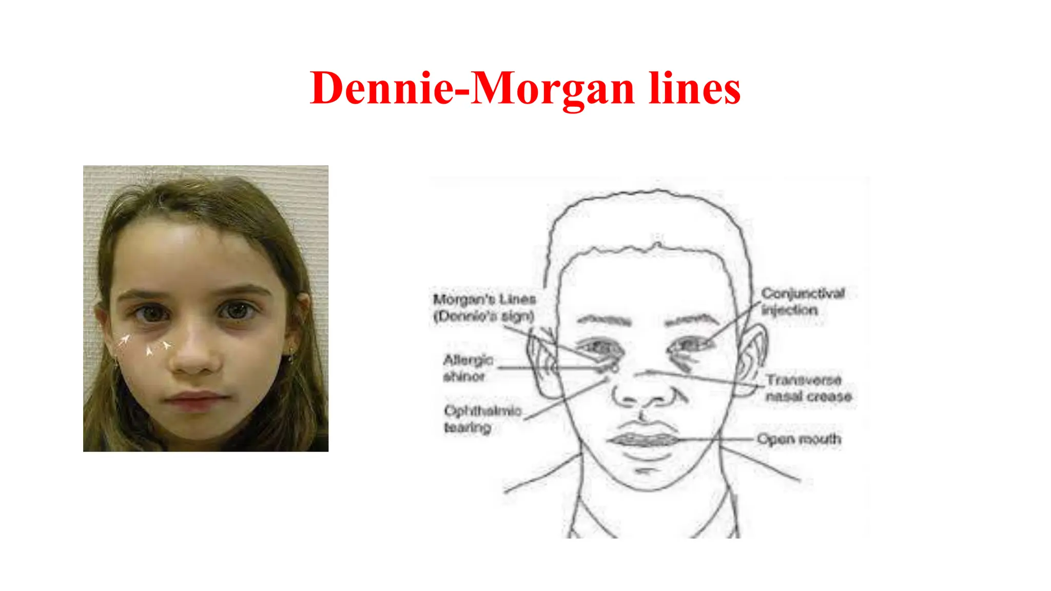 Allergic Rhinitis, cayse and mangement .pptx