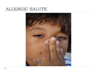 ALLERGIC RHINITIS 3600.pptx